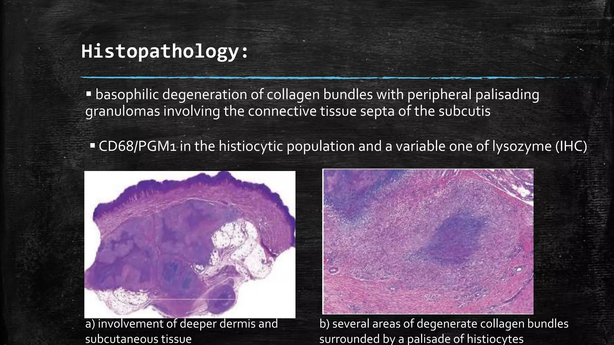 Panniculitis.rooks.dermatology | PPTX | Skin and Dermatology | Diseases ...
