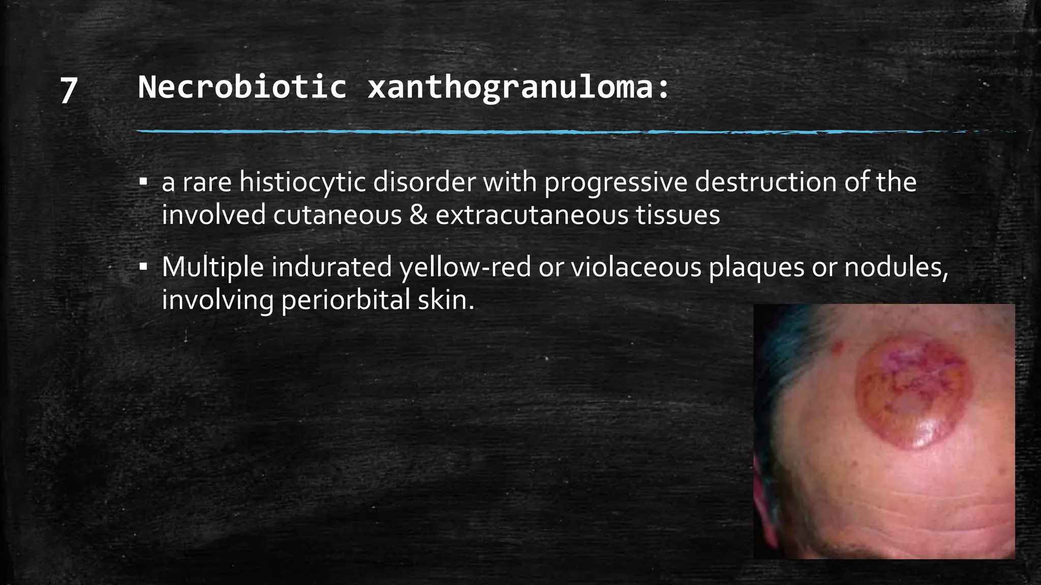 Panniculitis.rooks.dermatology | PPTX | Skin and Dermatology | Diseases ...