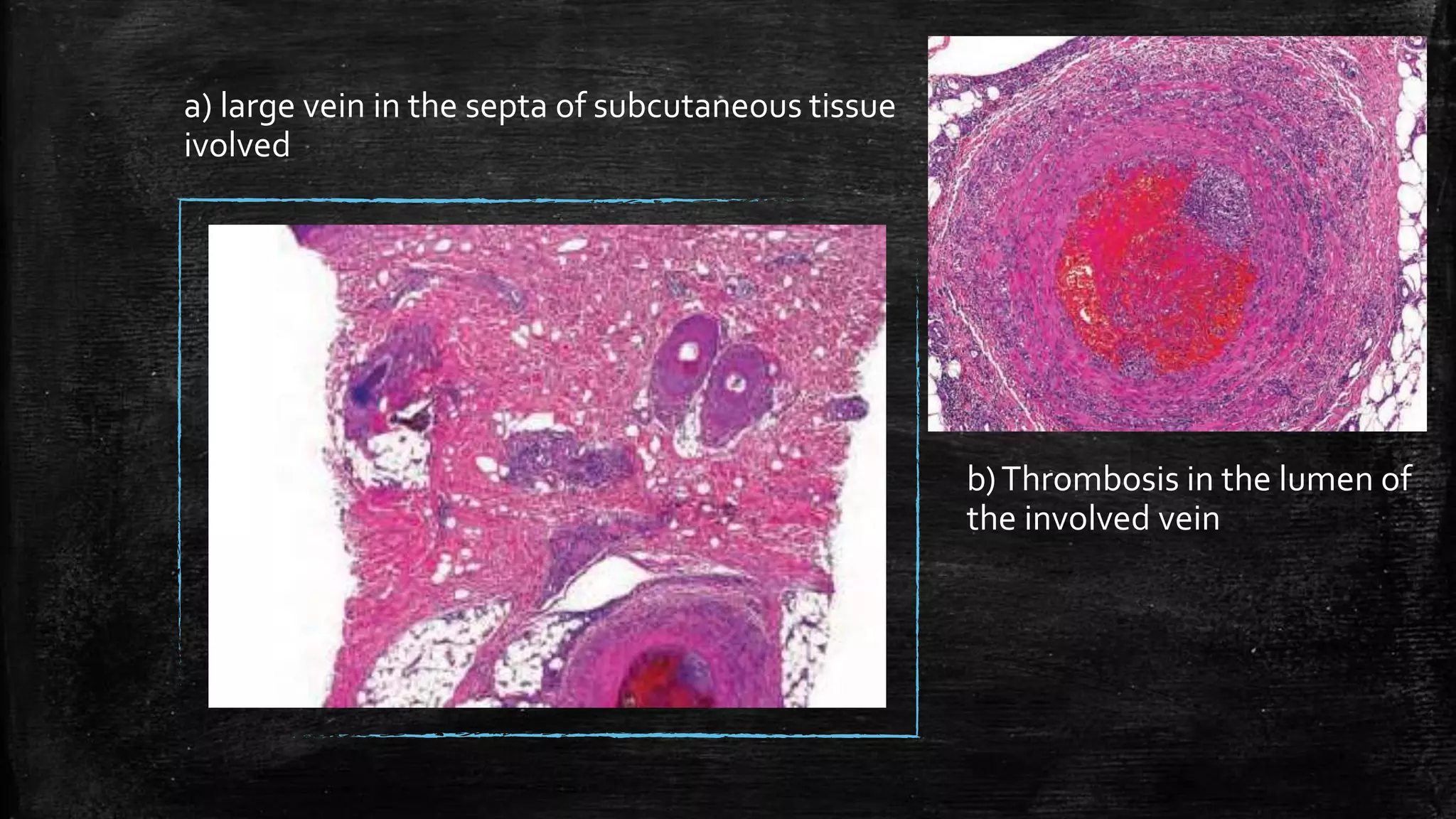 Panniculitis.rooks.dermatology | PPTX | Skin and Dermatology | Diseases ...