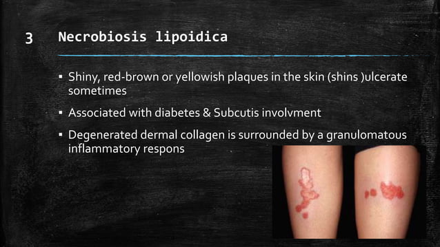 Panniculitis.rooks.dermatology | PPTX | Skin and Dermatology | Diseases ...