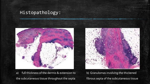 Panniculitis.rooks.dermatology | PPTX | Skin and Dermatology | Diseases ...