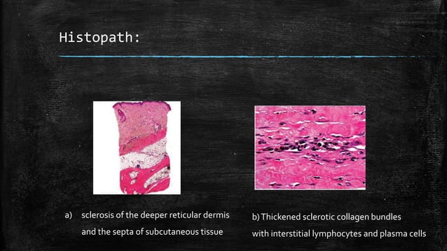 Panniculitis.rooks.dermatology | PPTX | Skin and Dermatology | Diseases ...