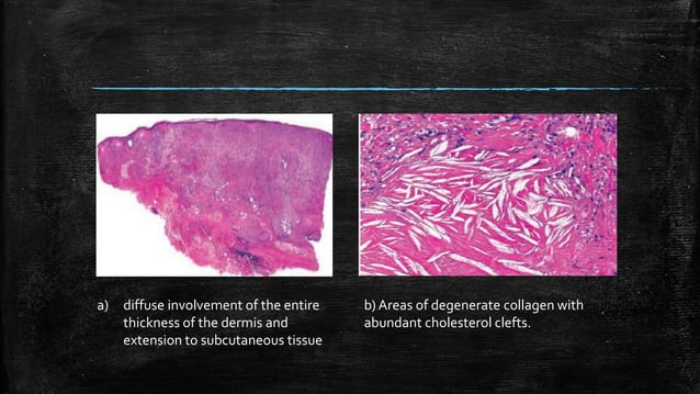 Panniculitis.rooks.dermatology | PPTX | Skin and Dermatology | Diseases ...