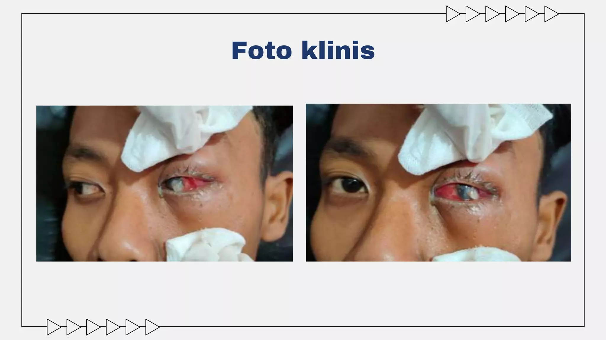 Panoftalmitis OS.pptx