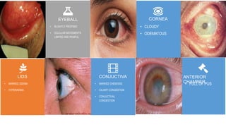 Panophthalmitis | PPTX