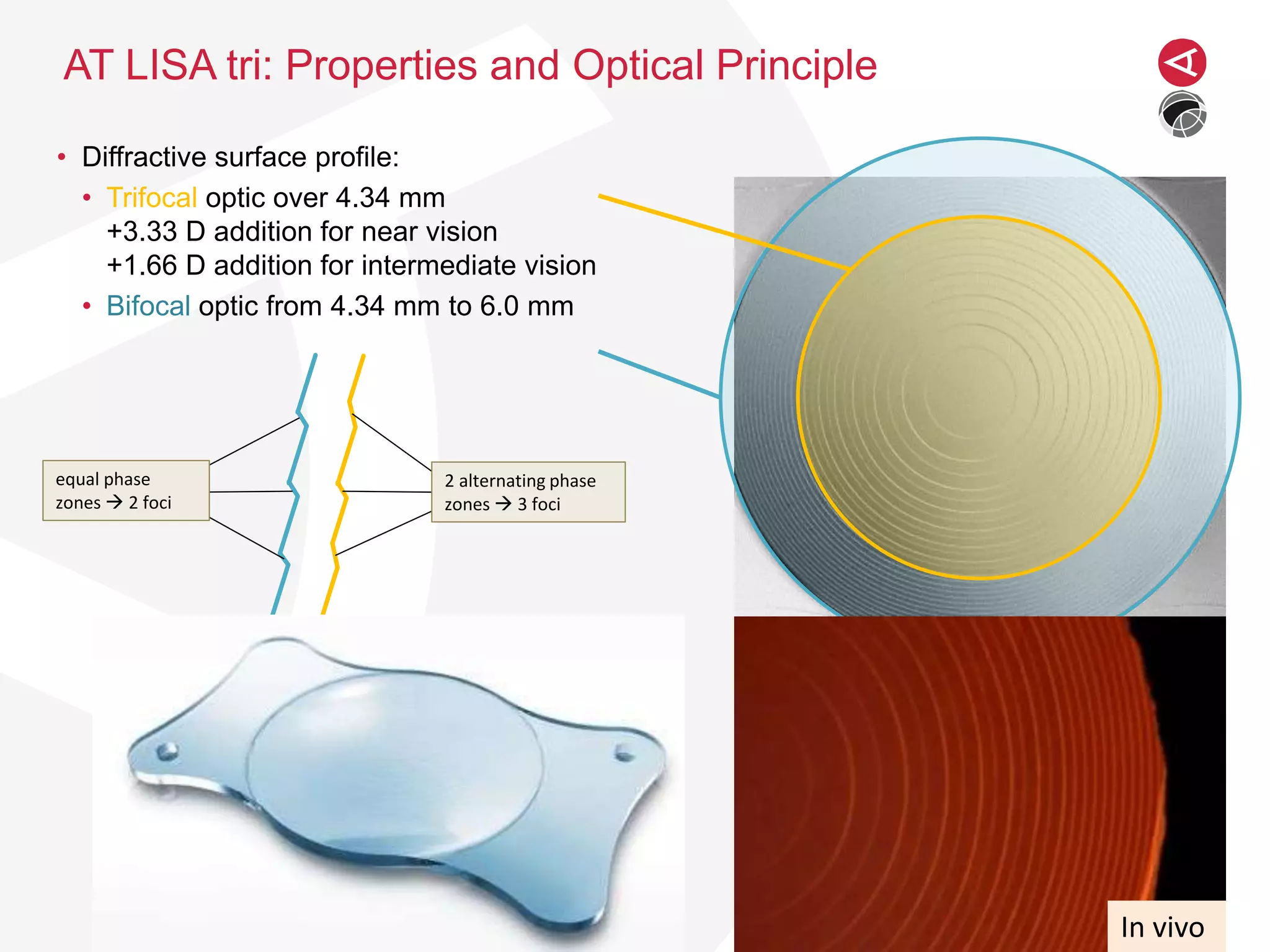 New Versus Former-Generation Diffractive Trifocal Intraocular Lens | PPTX