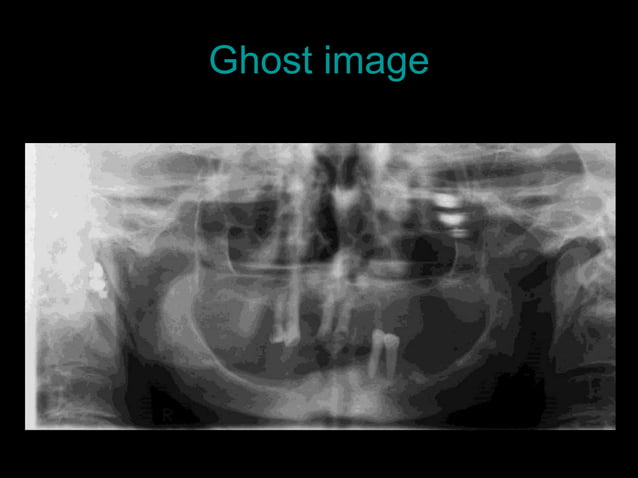 Panoramic-radiography.ppt | Dental Health | Diseases and Conditions