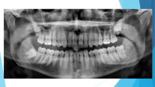 Panoramic radiograph | PPTX
