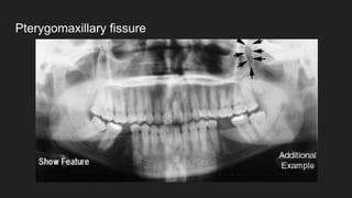 Pterygomaxillary Fissure Radiograph