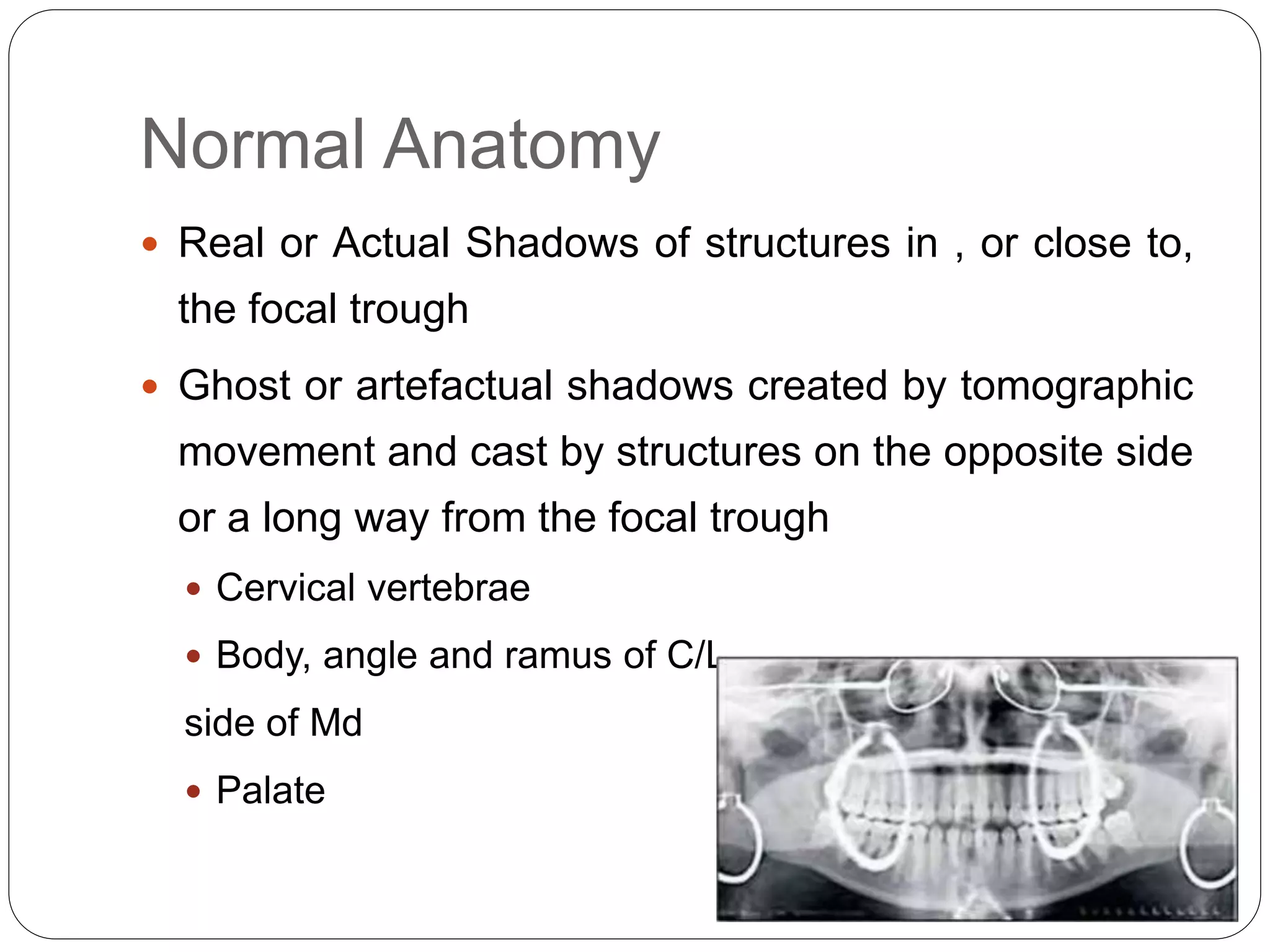 Panoramic radiography (dental panoramic tomography dpt) and periapical ...