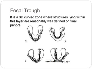 Panoramic radiography (dental panoramic tomography dpt) and periapical ...