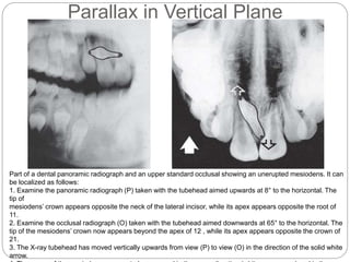 Panoramic radiography (dental panoramic tomography dpt) and periapical ...