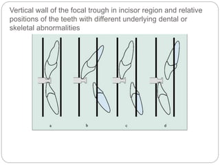 Panoramic radiography (dental panoramic tomography dpt) and periapical ...