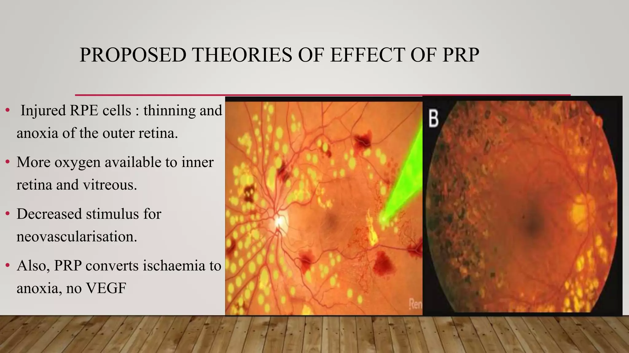 BASICS OF PAN RETINAL, SECTOR AND FOCAL RETINAL LASER PHOTOCOAGULATION.pptx