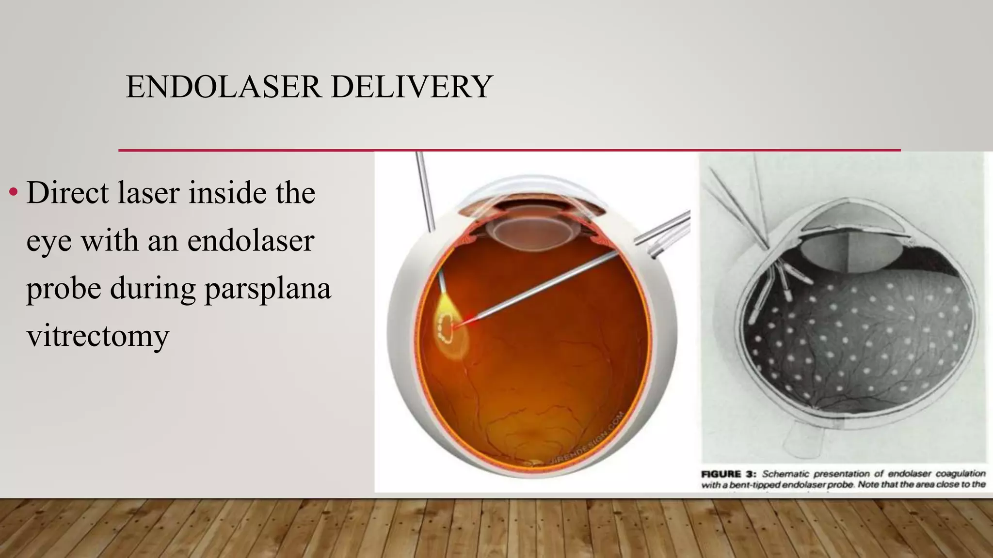 BASICS OF PAN RETINAL, SECTOR AND FOCAL RETINAL LASER PHOTOCOAGULATION.pptx
