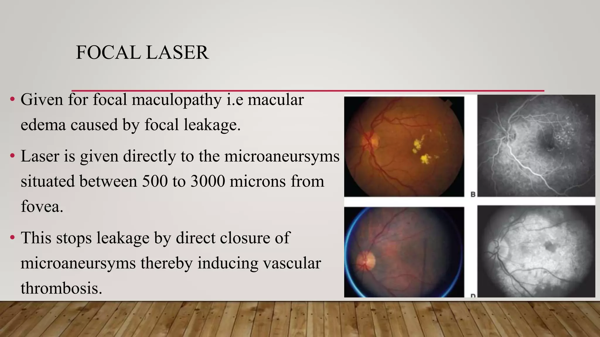 BASICS OF PAN RETINAL, SECTOR AND FOCAL RETINAL LASER PHOTOCOAGULATION.pptx