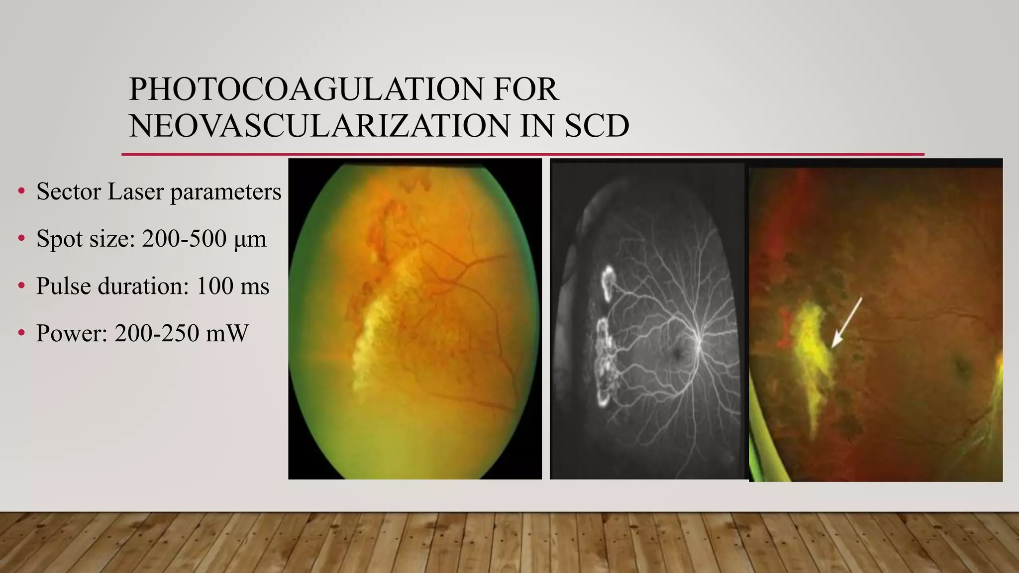 BASICS OF PAN RETINAL, SECTOR AND FOCAL RETINAL LASER PHOTOCOAGULATION.pptx