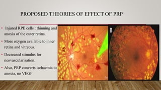 BASICS OF PAN RETINAL, SECTOR AND FOCAL RETINAL LASER PHOTOCOAGULATION.pptx