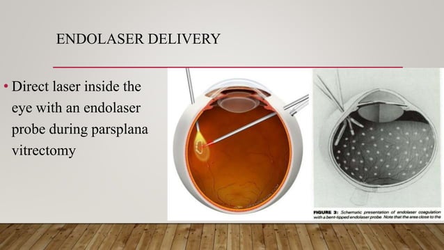 BASICS OF PAN RETINAL, SECTOR AND FOCAL RETINAL LASER PHOTOCOAGULATION ...