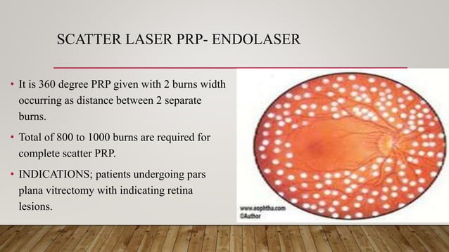 BASICS OF PAN RETINAL, SECTOR AND FOCAL RETINAL LASER PHOTOCOAGULATION ...