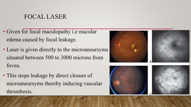 BASICS OF PAN RETINAL, SECTOR AND FOCAL RETINAL LASER PHOTOCOAGULATION ...