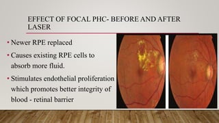BASICS OF PAN RETINAL, SECTOR AND FOCAL RETINAL LASER PHOTOCOAGULATION.pptx