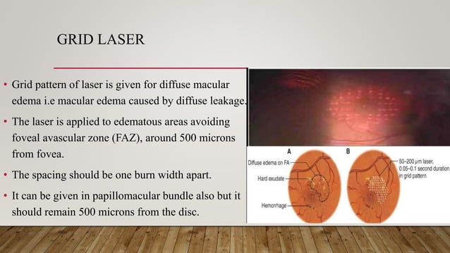 BASICS OF PAN RETINAL, SECTOR AND FOCAL RETINAL LASER PHOTOCOAGULATION ...