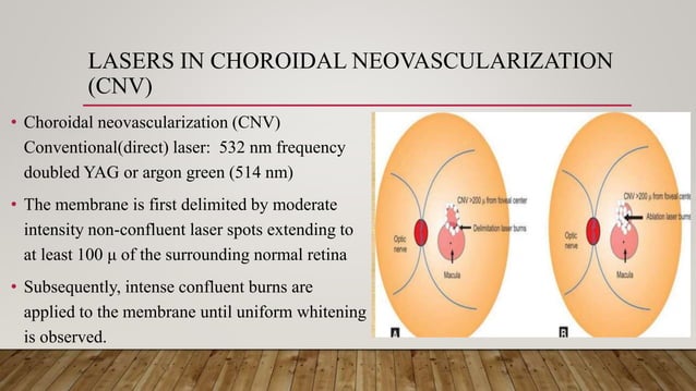 BASICS OF PAN RETINAL, SECTOR AND FOCAL RETINAL LASER PHOTOCOAGULATION ...