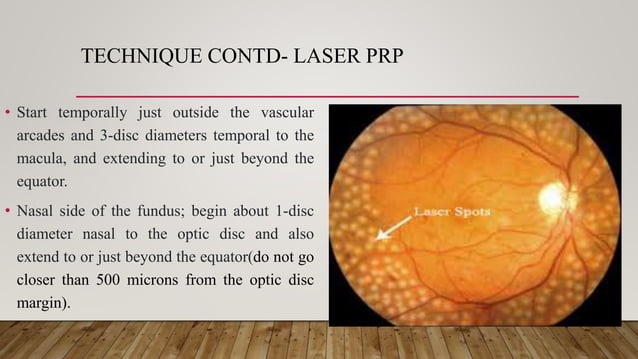 BASICS OF PAN RETINAL, SECTOR AND FOCAL RETINAL LASER PHOTOCOAGULATION.pptx