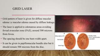 Focal Laser Photocoagulation