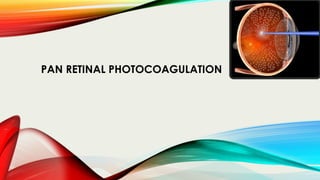 All about Pan Retinal Photocoagulation.pptx