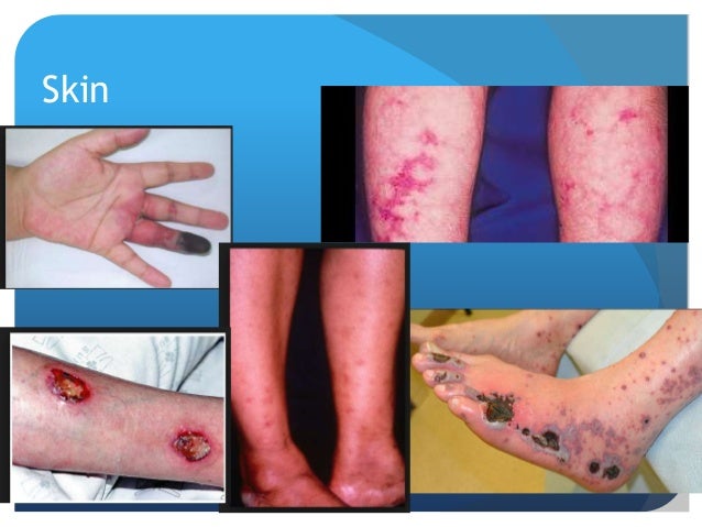 Polyarteritis Nodosa Causes Symptoms And Treatments Global Treatment Services Pvt Ltd