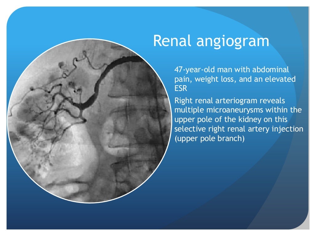 Polyarteritis nodosa