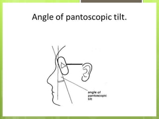 Pantoscopic tilt | PPTX