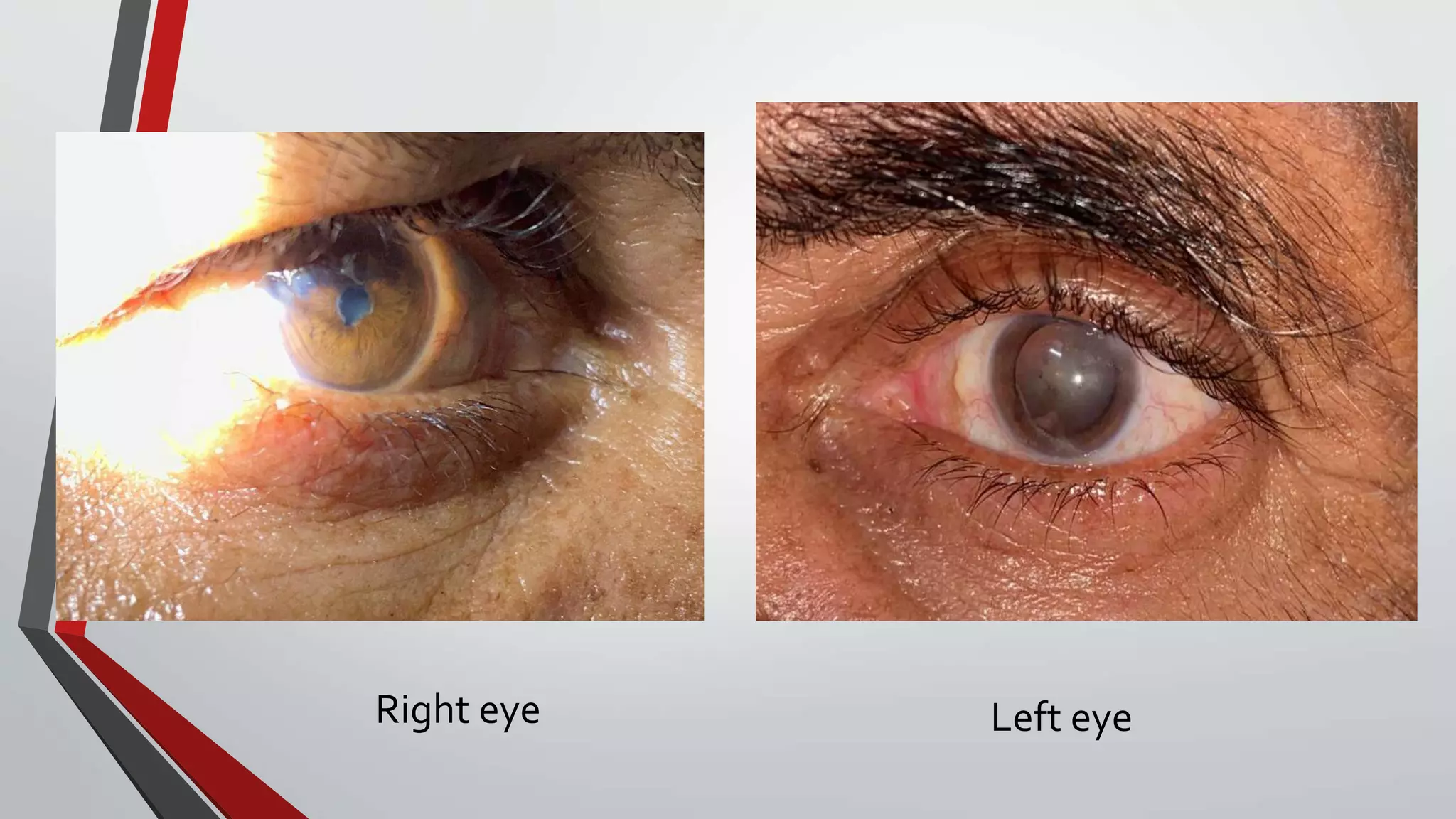 Pan-uveitis both eye (case presentation) | PPTX