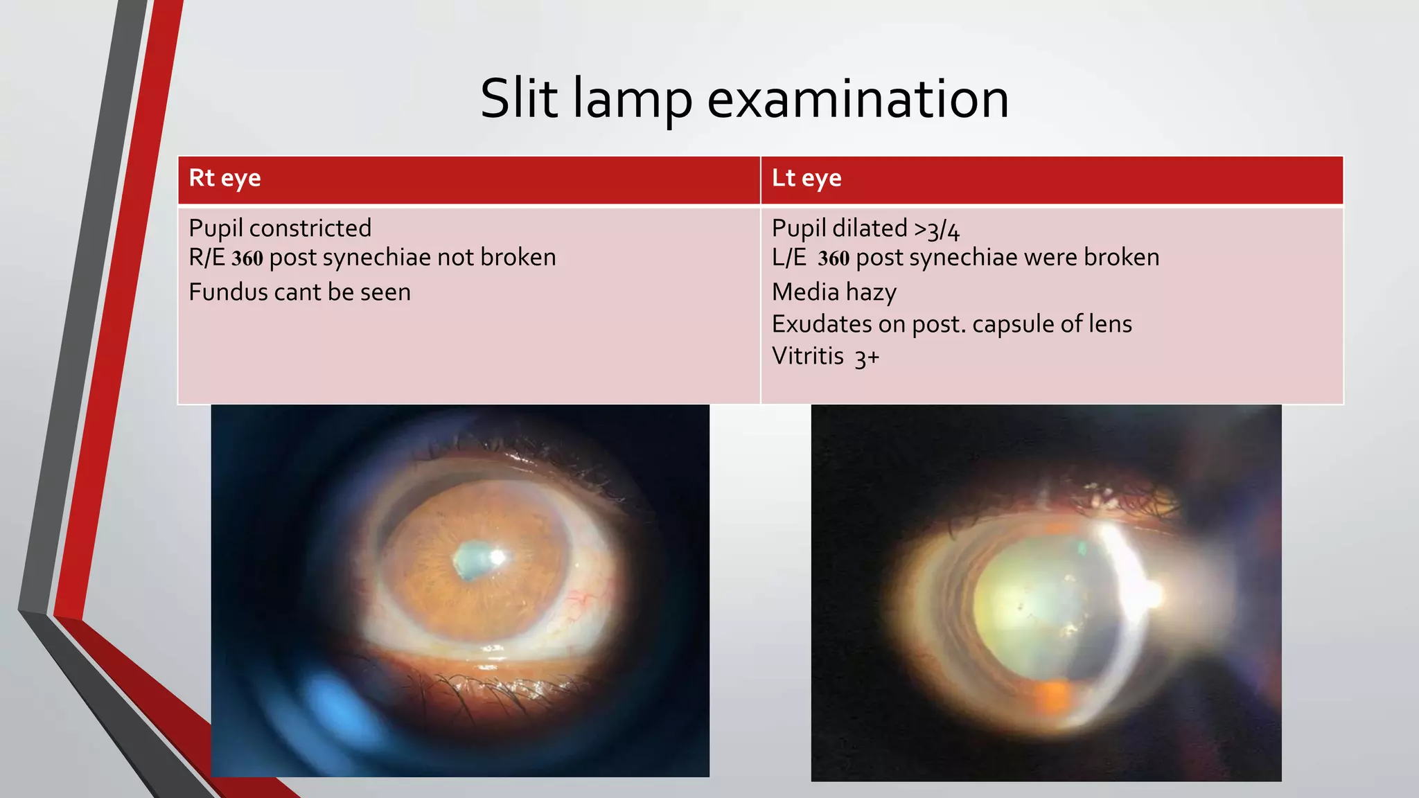 Pan-uveitis both eye (case presentation) | PPTX