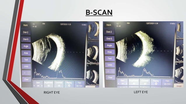 Pan-uveitis both eye (case presentation) | PPTX