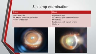 Pan-uveitis both eye (case presentation) | PPTX
