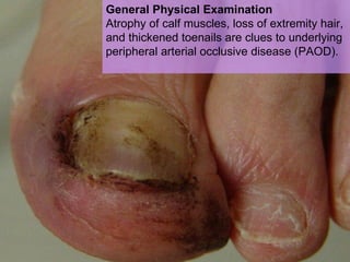 Peripheral arterial occlusive disease | PPT