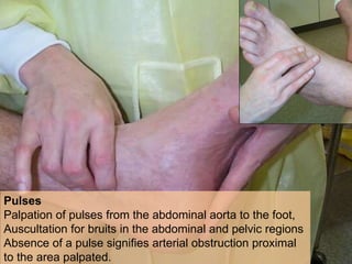 Peripheral arterial occlusive disease | PPT