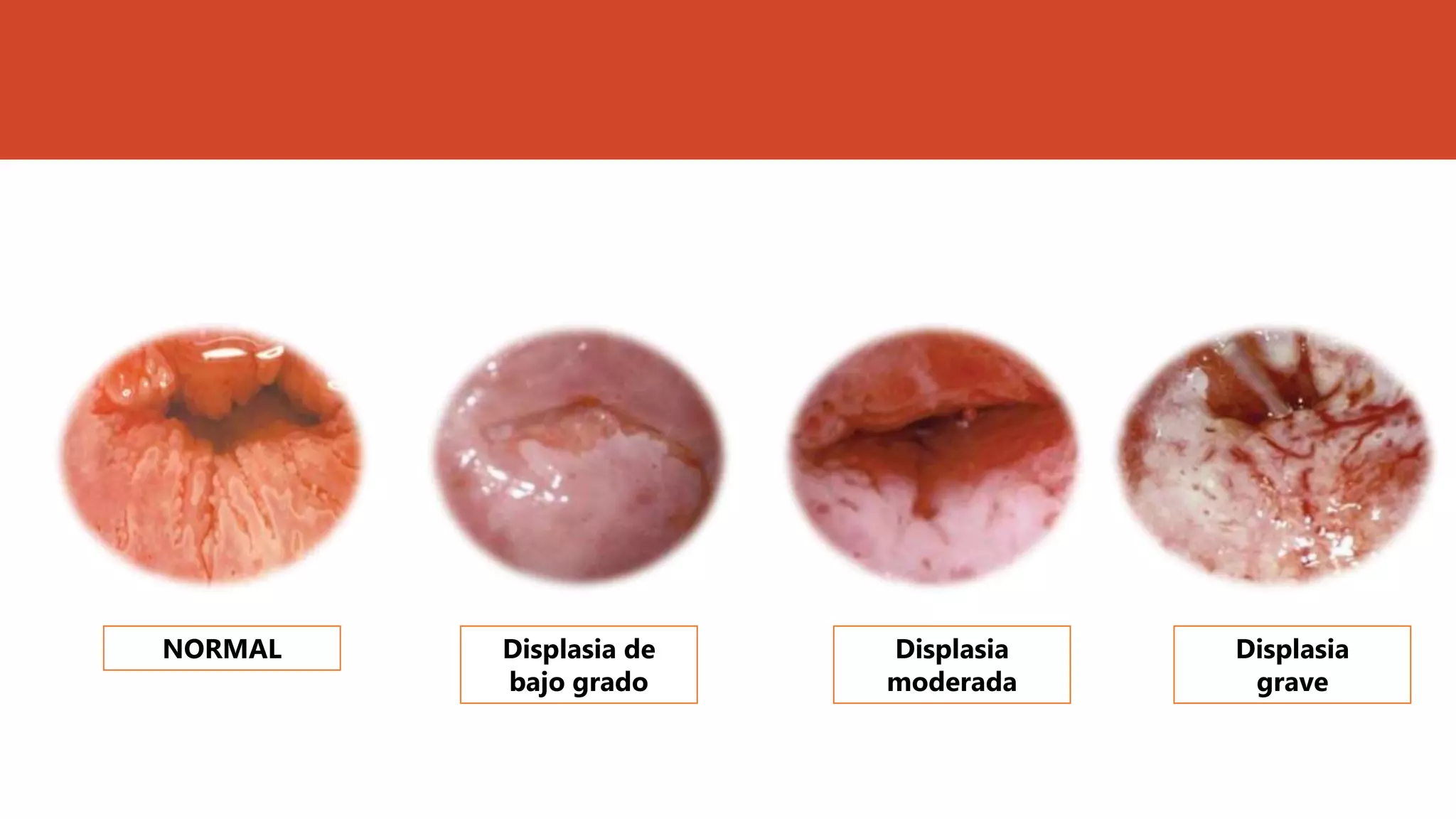 Papanicolaou, hpv,ca de cervix y colposcopia | PPTX