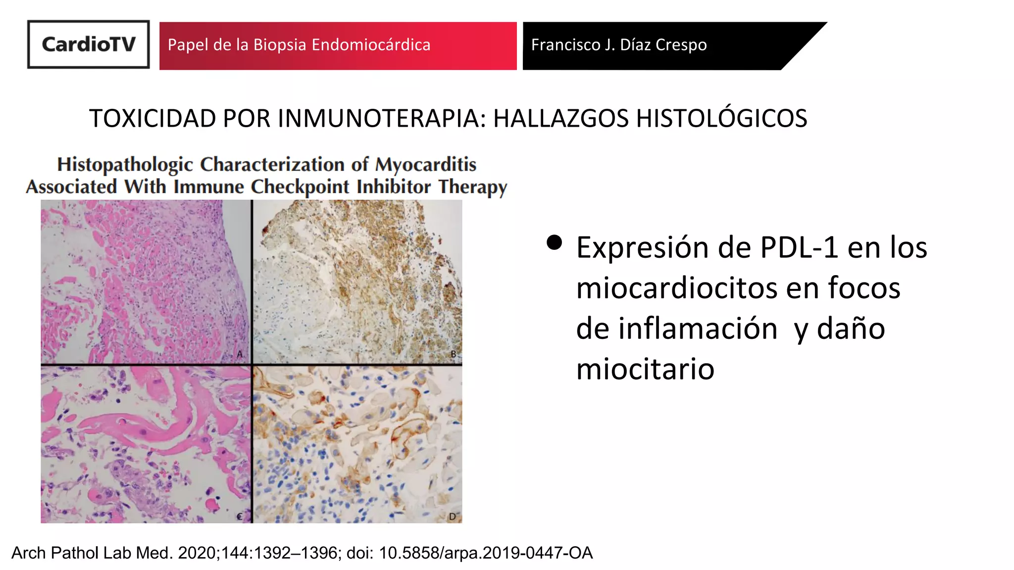 Papel de la biopsia endomiocárdica | PPT