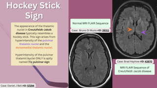 Papel de la resonancia magnética en las enfermedades neurodegenerativas.pdf