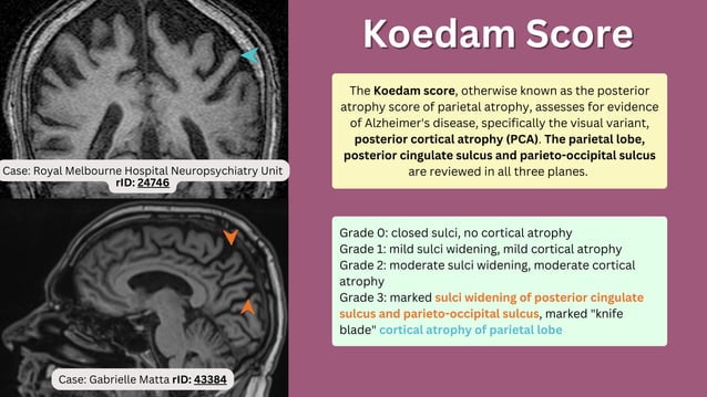 Papel de la resonancia magnética en las enfermedades neurodegenerativas.pdf