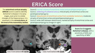 Papel de la resonancia magnética en las enfermedades neurodegenerativas.pdf