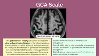 Papel de la resonancia magnética en las enfermedades neurodegenerativas.pdf
