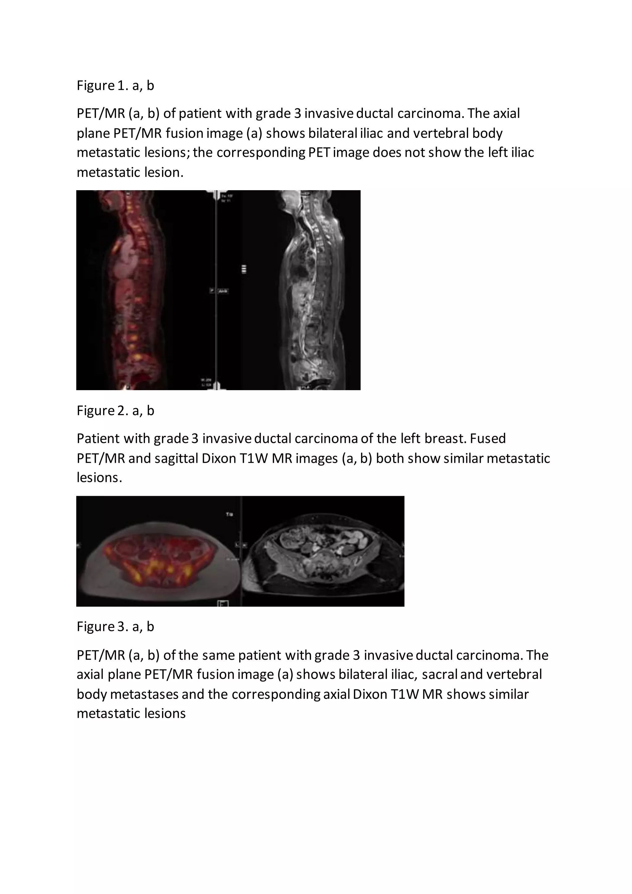 18F-FDG PET/MRI VS PET/CT IN DETECTION OF BONE METASTASIS IN BREAST CANCER PATIENT | PDF