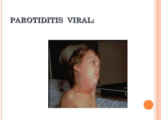 Parotiditis viral | PPT
