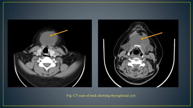 A CASE REPORT ONPAPILLARY THYROID CARCINOMA OF LARGE THYROGLOSSAL CYST.pptx