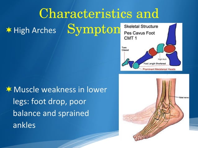 CMT slides: understand the disease. | PPT
